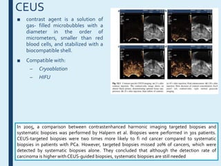 Focussed therapy and imaging in prostate cancer | PPTX