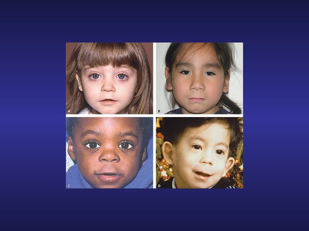 Foetal Alcohol Syndrome | PPT