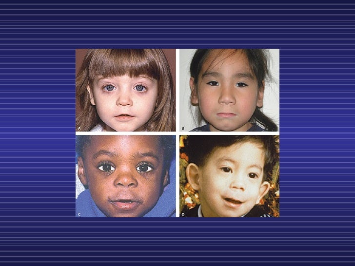 Foetal Alcohol Syndrome