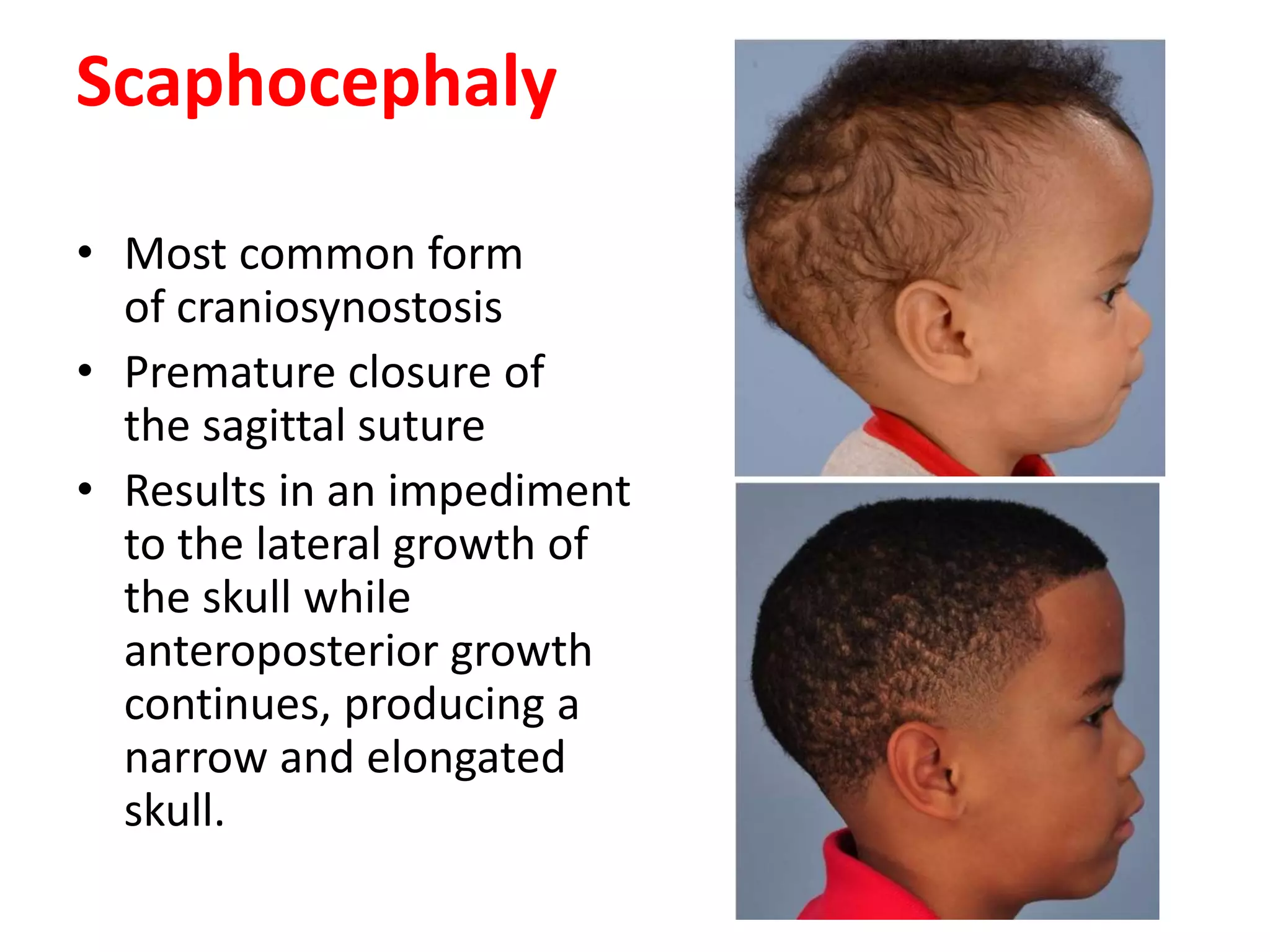 Foetal Skull Anatomy | PPTX