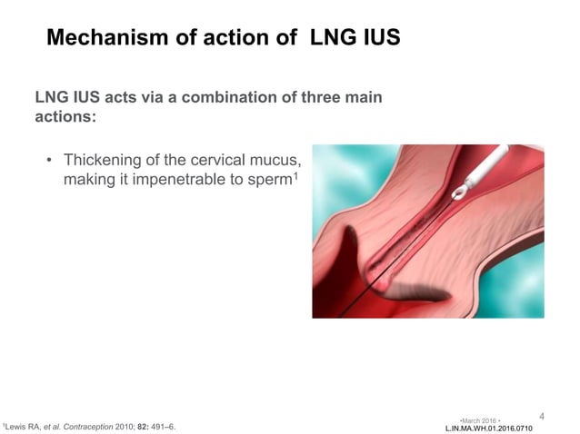 ole of LNG IUS in management of AUB (Levonorgestrel intrauterine system ...