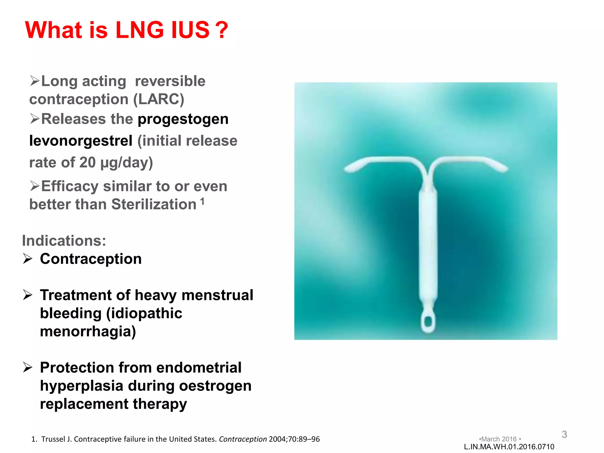 Role of LNG IUS in management of AUB (Levonorgestrel intrauterine ...