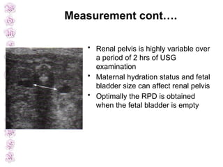 renal pelvic dilatation , antenatal managemnt and monitoring | PPTX
