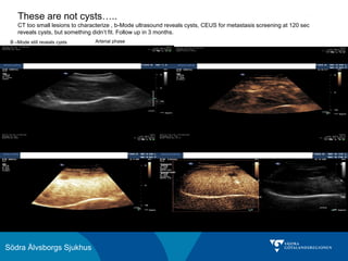 Contrast Enhanced Ultra Sound (CEUS) | PDF