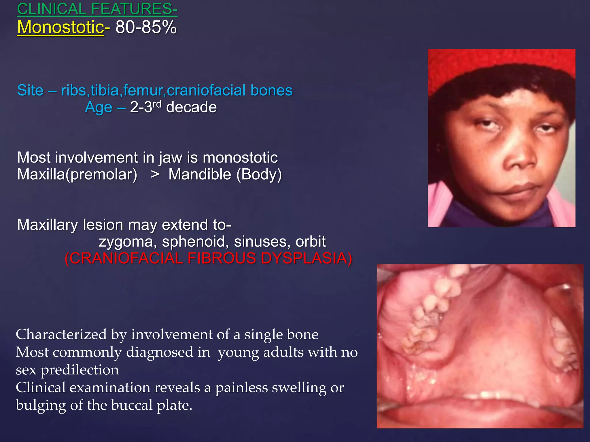 Fibro osseous lesions .pptx | Dental Health | Diseases and Conditions