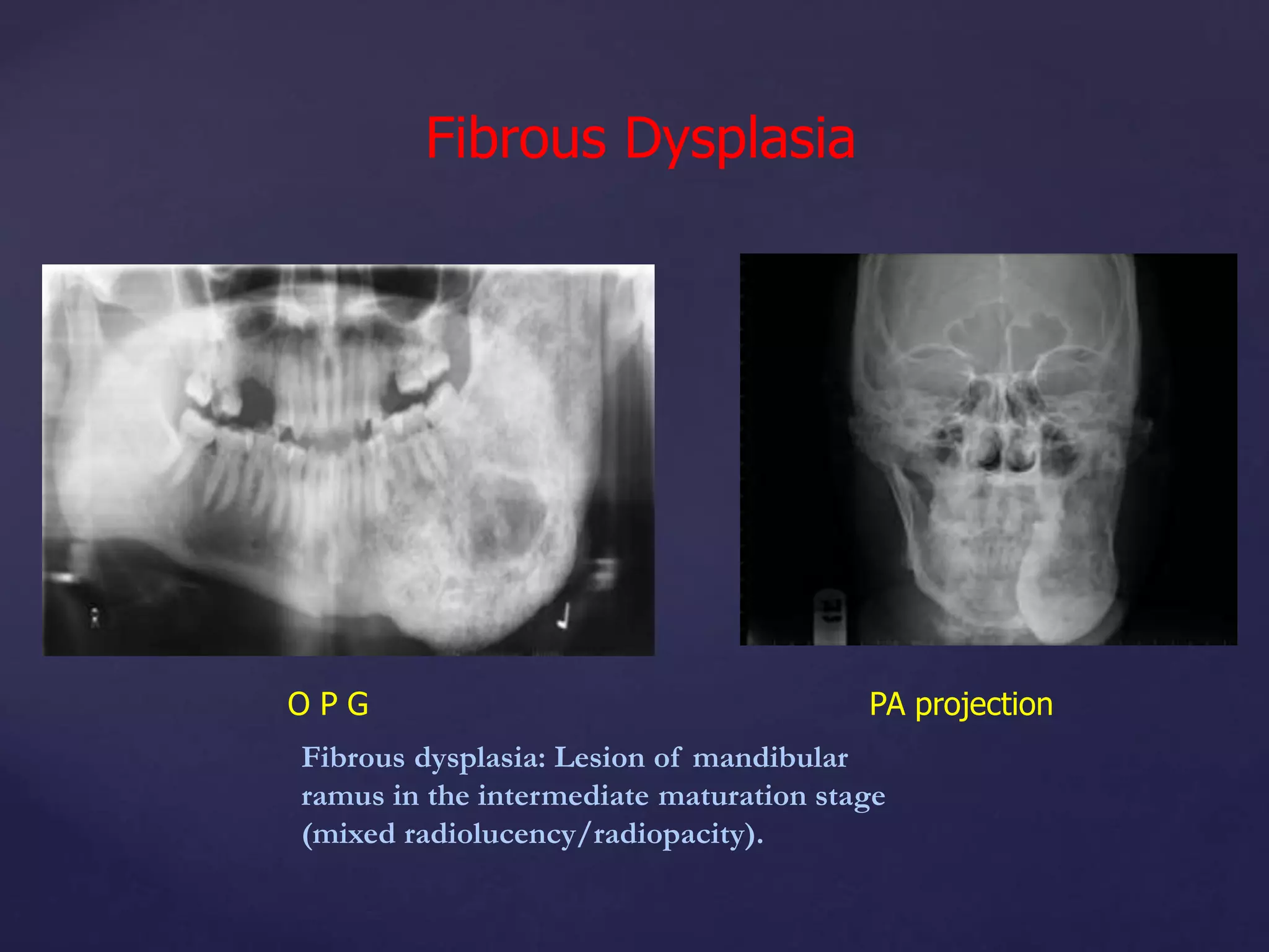 Fibro osseous lesions .pptx | Dental Health | Diseases and Conditions