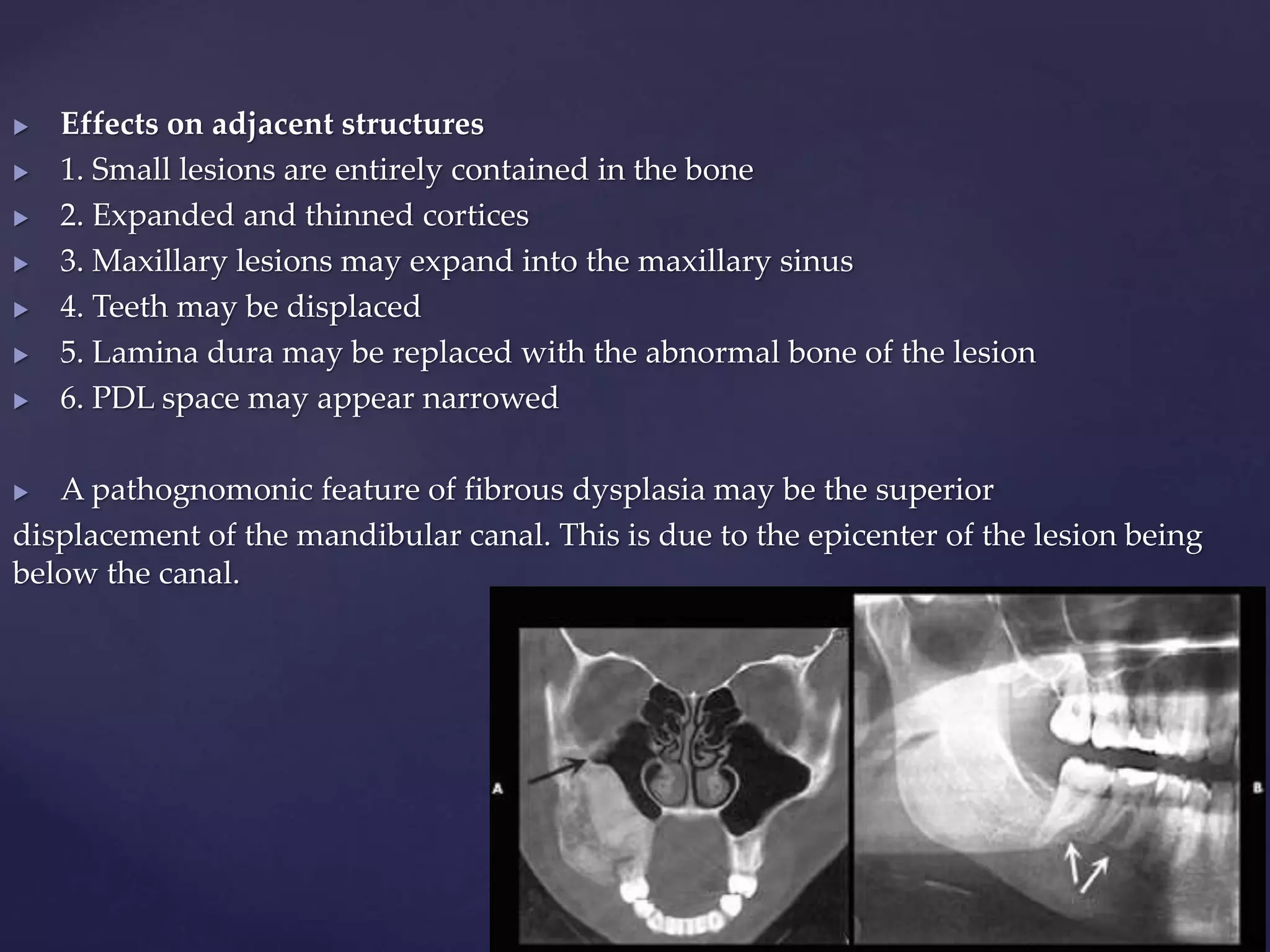 Fibro osseous lesions .pptx | Dental Health | Diseases and Conditions