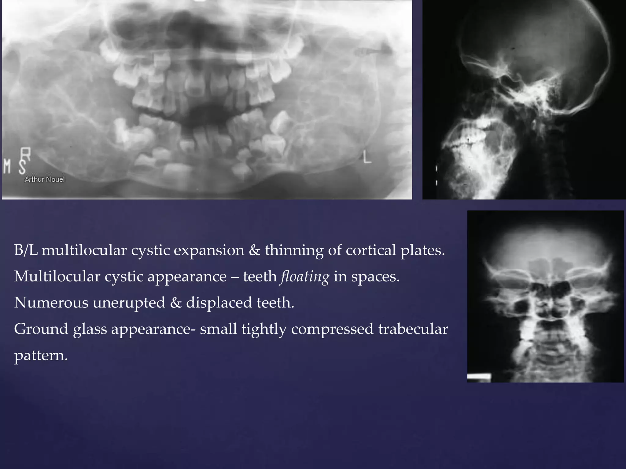 Fibro osseous lesions .pptx | Dental Health | Diseases and Conditions
