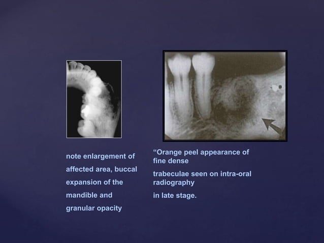 Fibro osseous lesions .pptx | Dental Health | Diseases and Conditions
