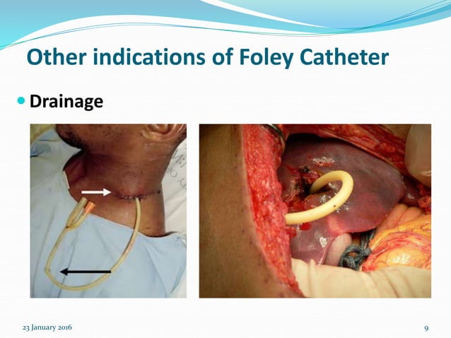 Foley cathetar and cathetarazation | PPTX