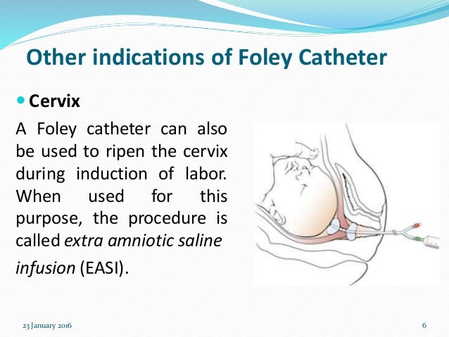 Foley cathetar and cathetarazation