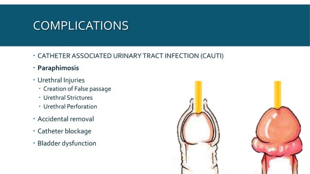 Foley catheterization | PPTX | Sexual Conditions | Sexual Health