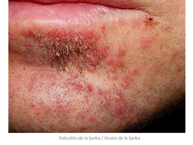 FOLICULITIS de la barba