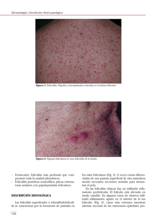 Foliculitis | PDF