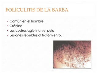 Foliculitis, furunculosis y hidrosadenitis | PPTX