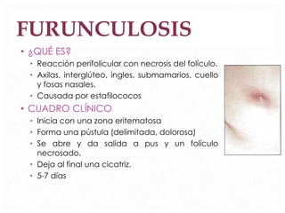 Foliculitis, furunculosis y hidrosadenitis | PPTX