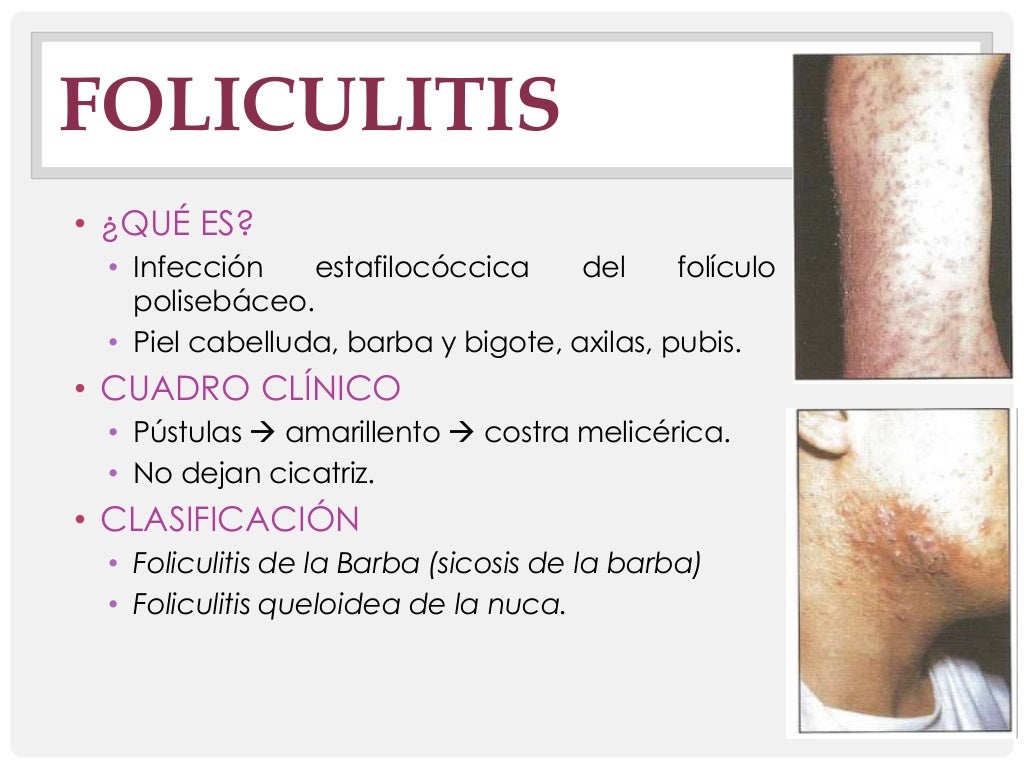 Foliculitis, furunculosis y hidrosadenitis