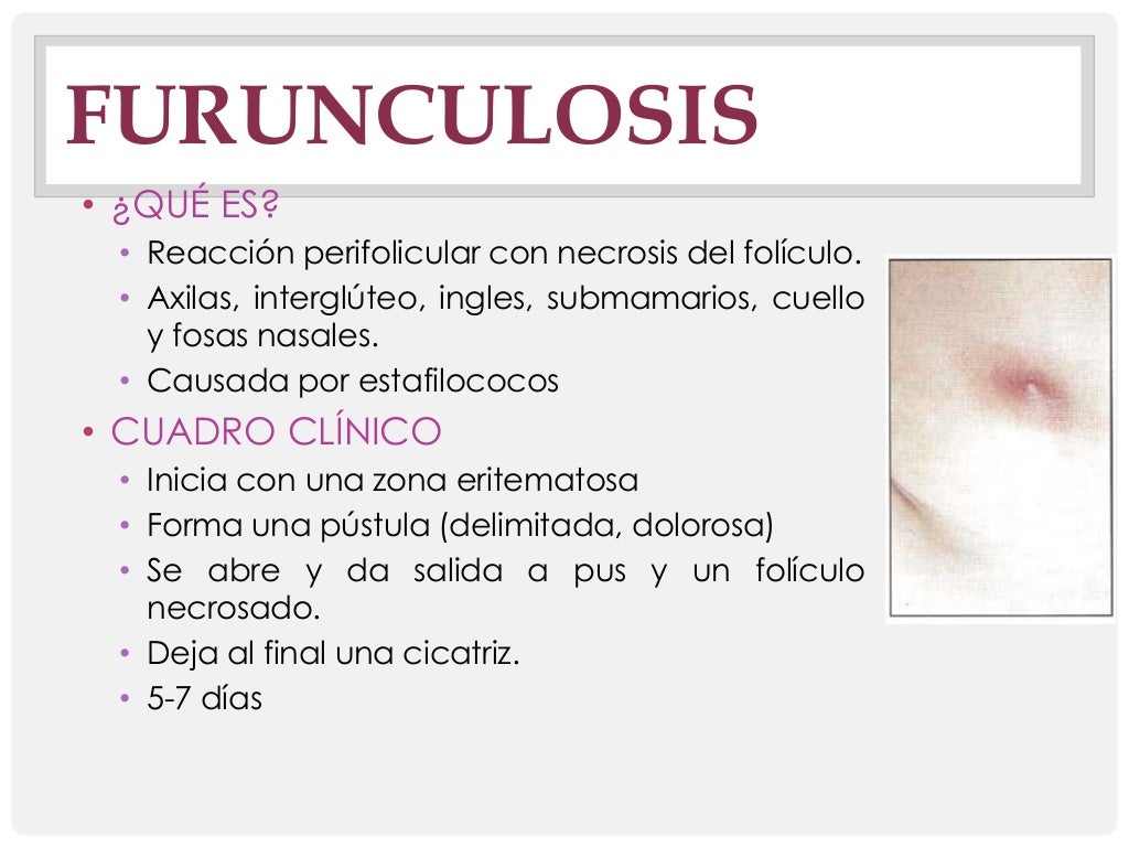 Foliculitis, furunculosis y hidrosadenitis
