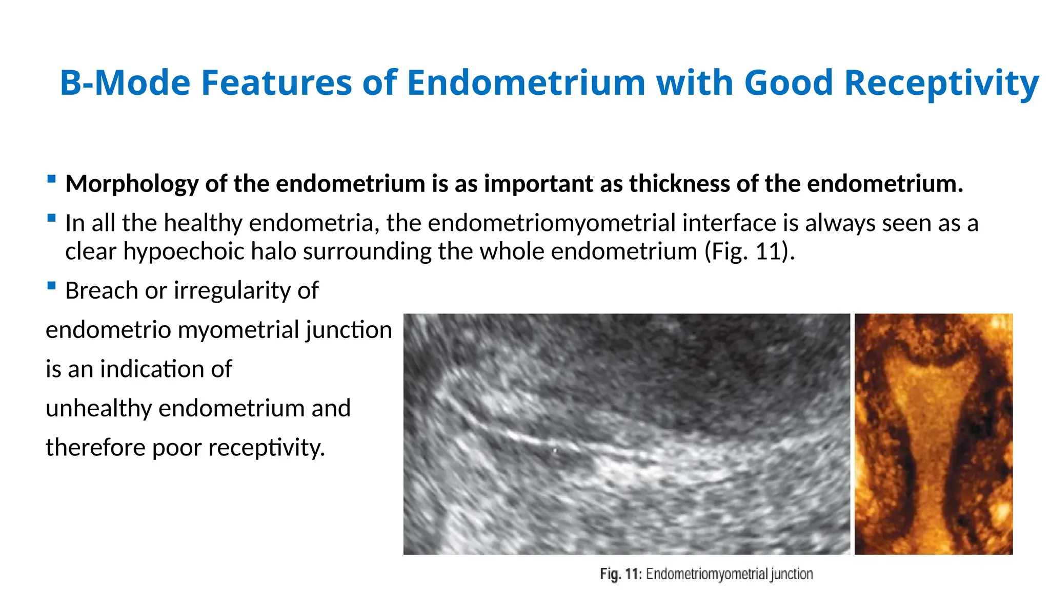 Follicle Monitoring: A Key to Optimized Fertility Treatment | PPTX