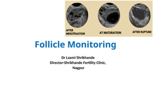 Follicle Monitoring: A Key to Optimized Fertility Treatment | PPTX