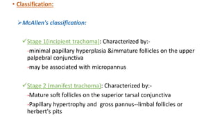 Follicular conjunctivitis (1) | PPTX