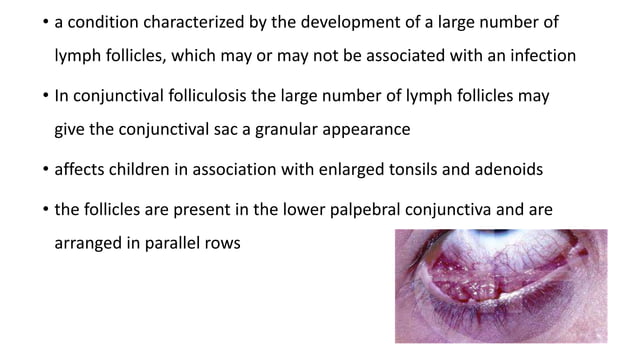 Follicular conjunctivitis (1) | PPTX | Eye and Vision Conditions ...