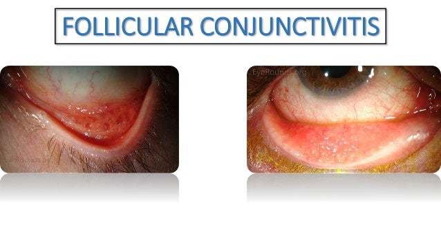 Histologia Da Conjuntivite Folicular