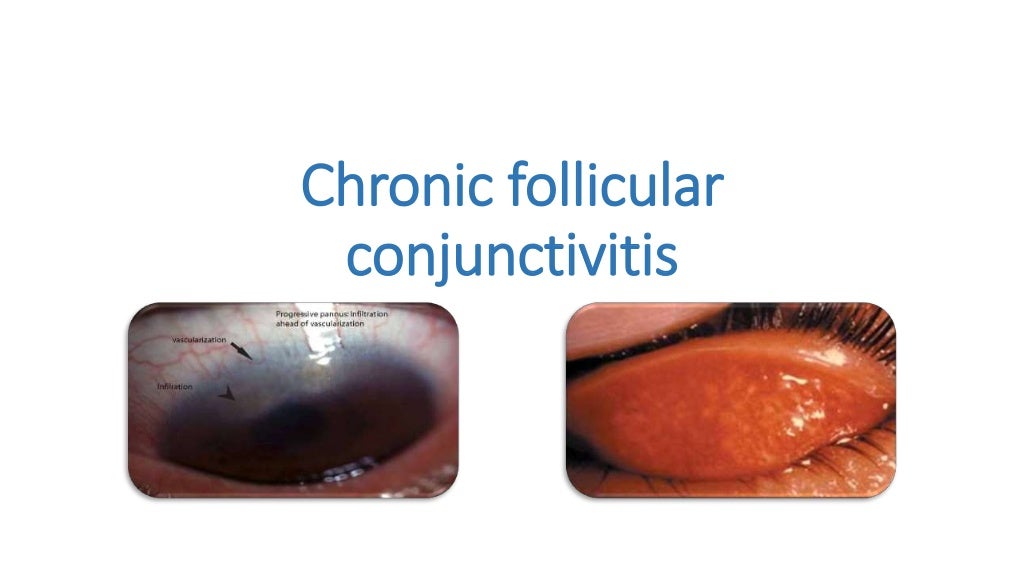 Follicular conjunctivitis (1)