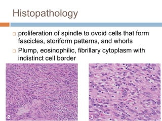 Follicular dendritic cell sarcoma | PPT