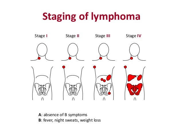 Follicular lymphoma