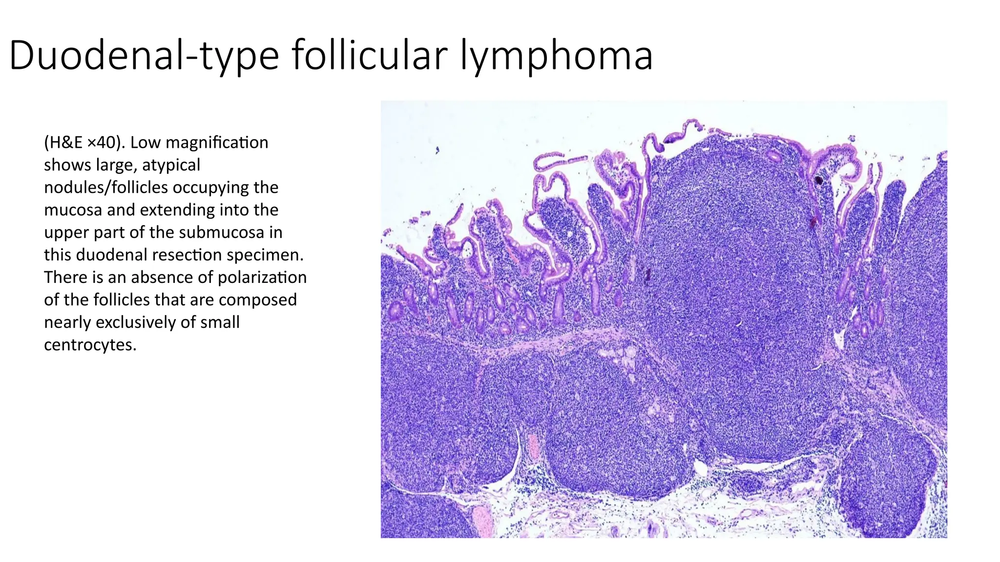 follicular lymphoma follicular lymphoma yasmin | PPTX