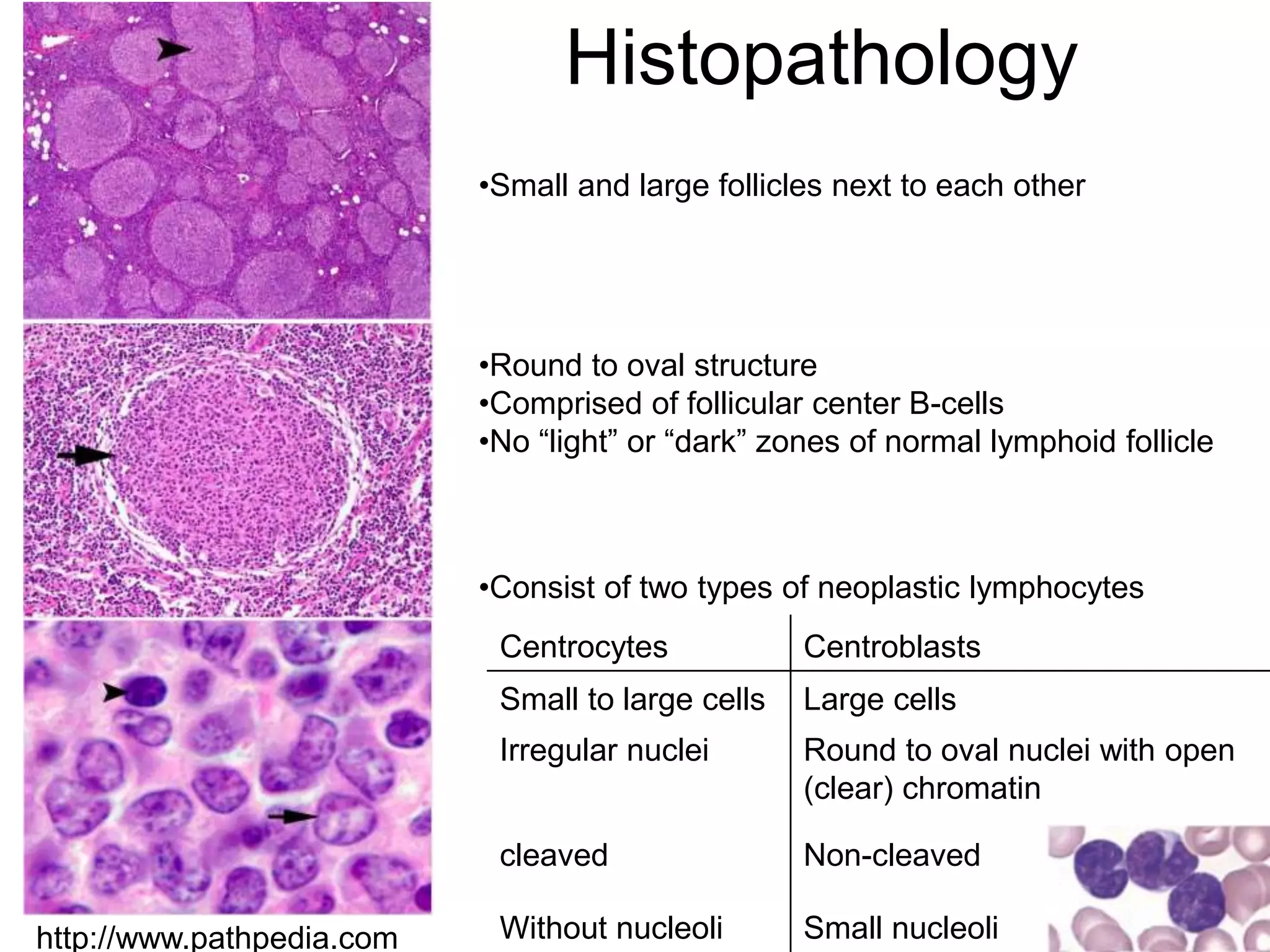 follicular lymphoma PPT无注释.ppt | Cancer | Diseases and Conditions