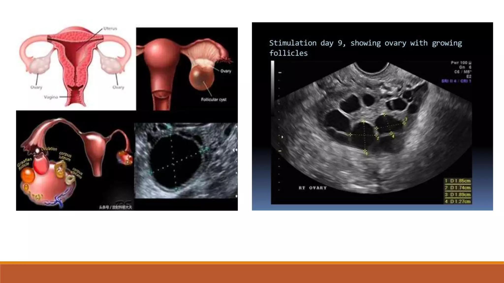 FOLLICULAR STUDY AND PATIENT MONITORING.pptx