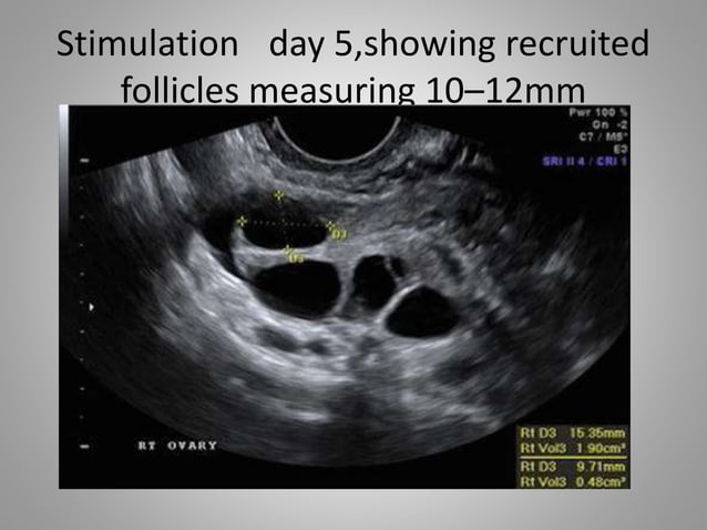 Follicular study | PPTX | Pregnancy | Reproductive Health