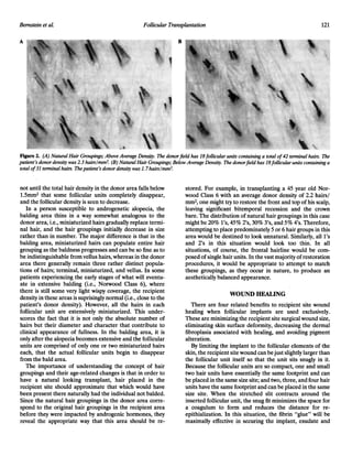 Follicular Transplantation | PDF