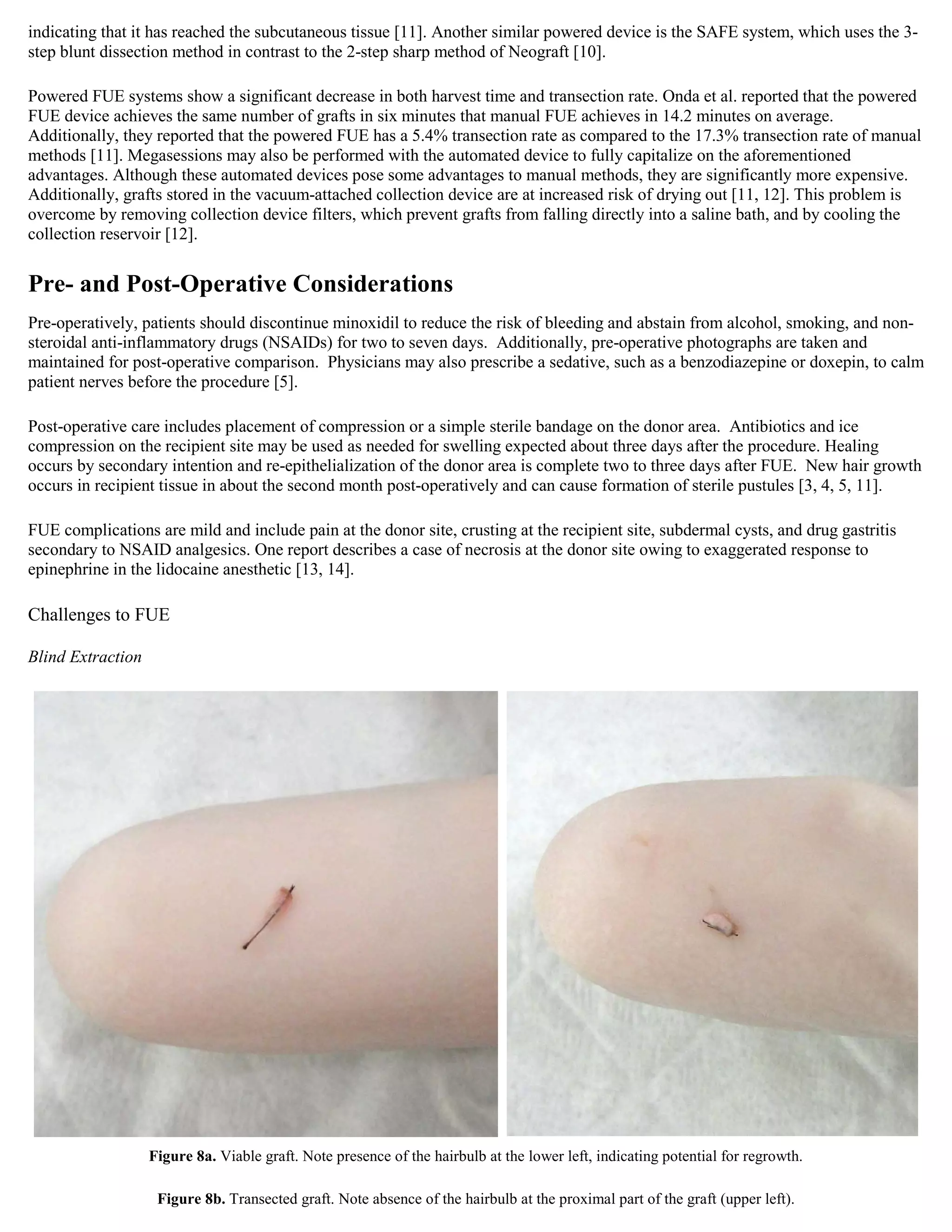 Follicular Unit Extraction Hair Transplant Harvest: A Review of Current ...