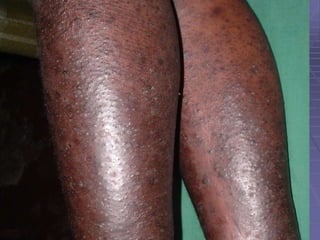 Folliculitis Ppt