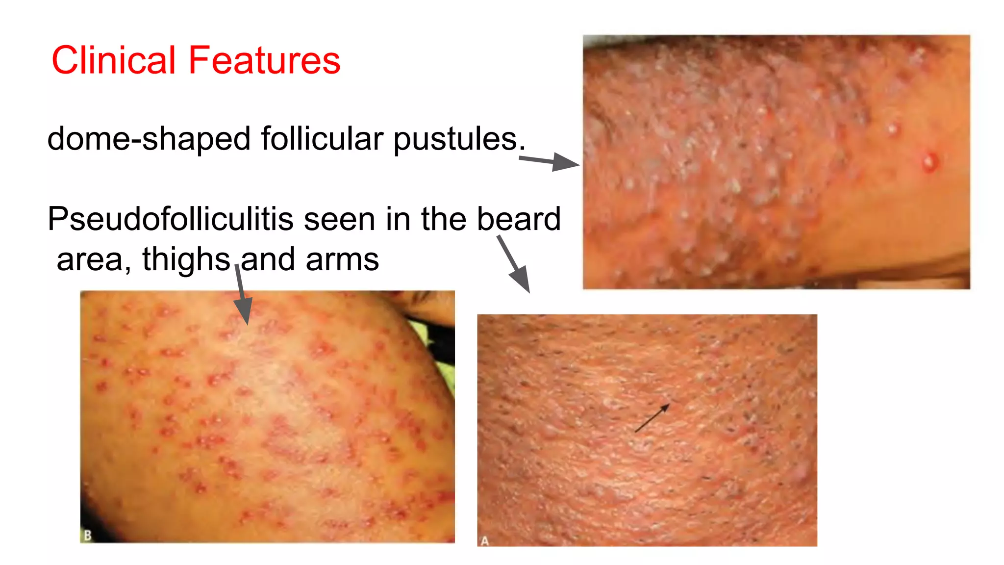 Folliculitis,boil( Furuncle), carbuncle | PDF
