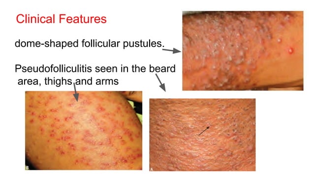 Folliculitis,boil( Furuncle), carbuncle