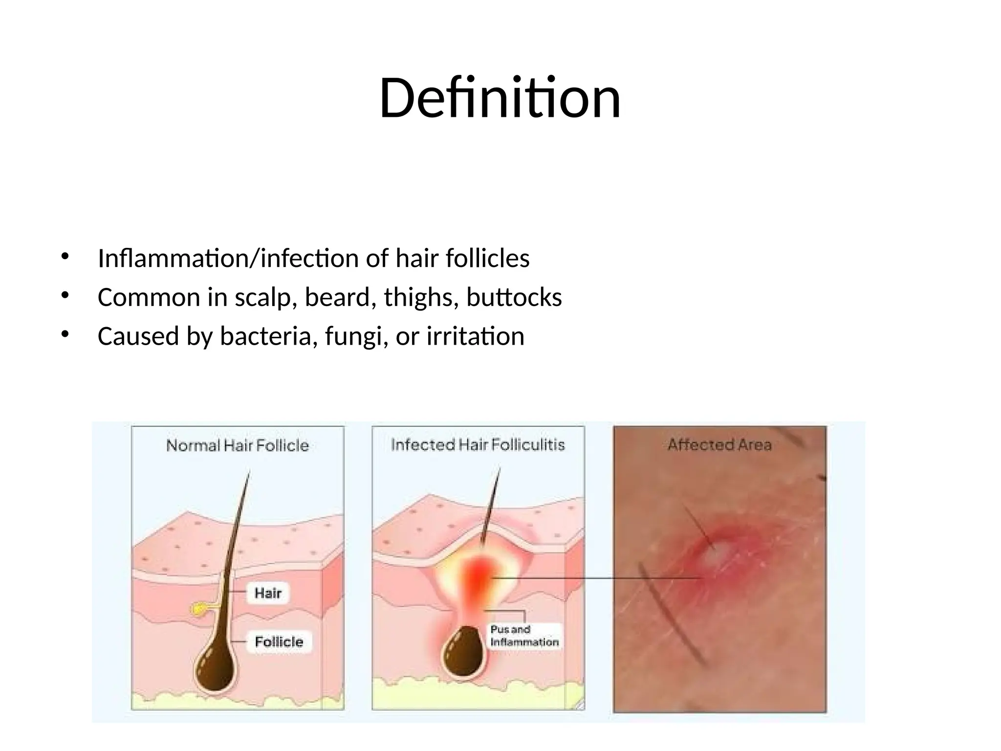 presentation on Folliculitis & Callositis | PPTX