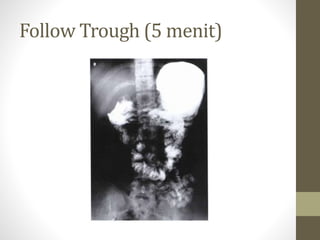 ppt kritisi dan evaluasi radiograf Follow through | PPTX