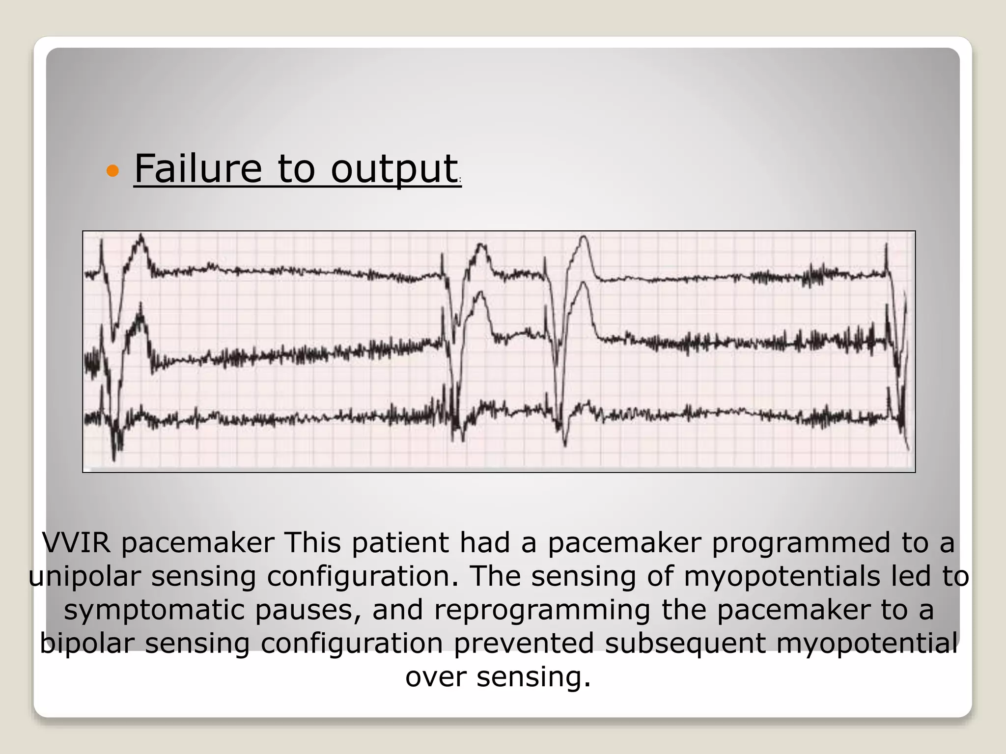 Follow up and management of pacemaker programming and | PPTX