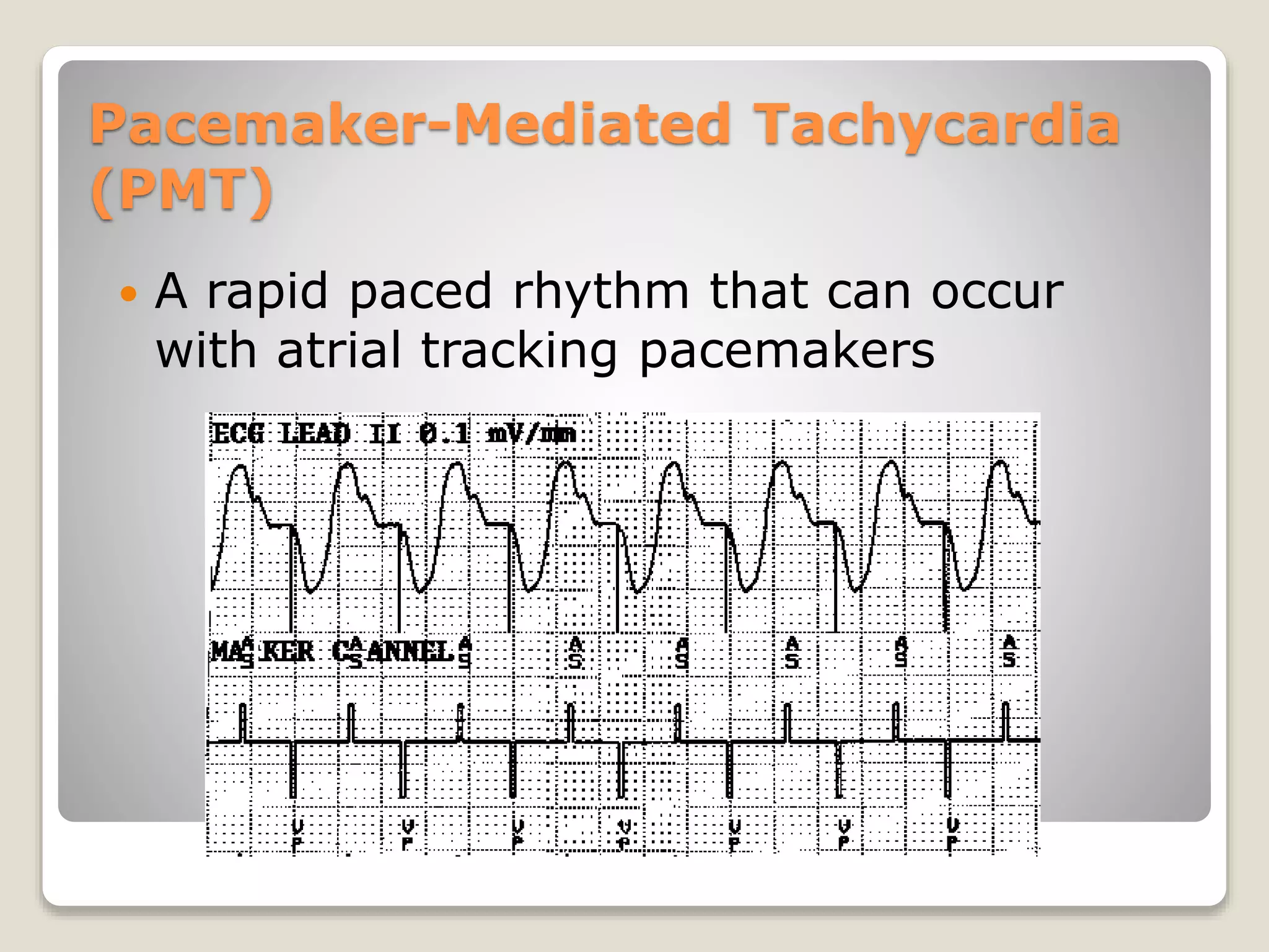 Follow up and management of pacemaker programming and | PPTX
