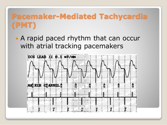 Follow up and management of pacemaker programming and