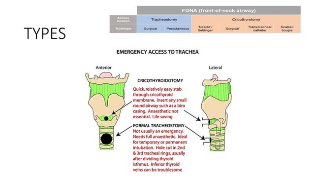 Front of neck access for difficult airway | PPTX | Ear, Nose and Throat ...
