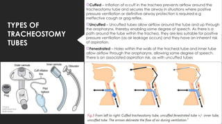 FONA (Front Of Neck Access) in emergency.pptx