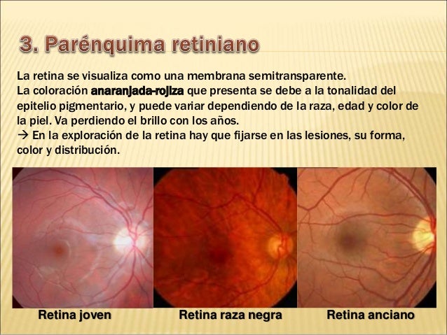 Fondo de ojo en Atención Primaria