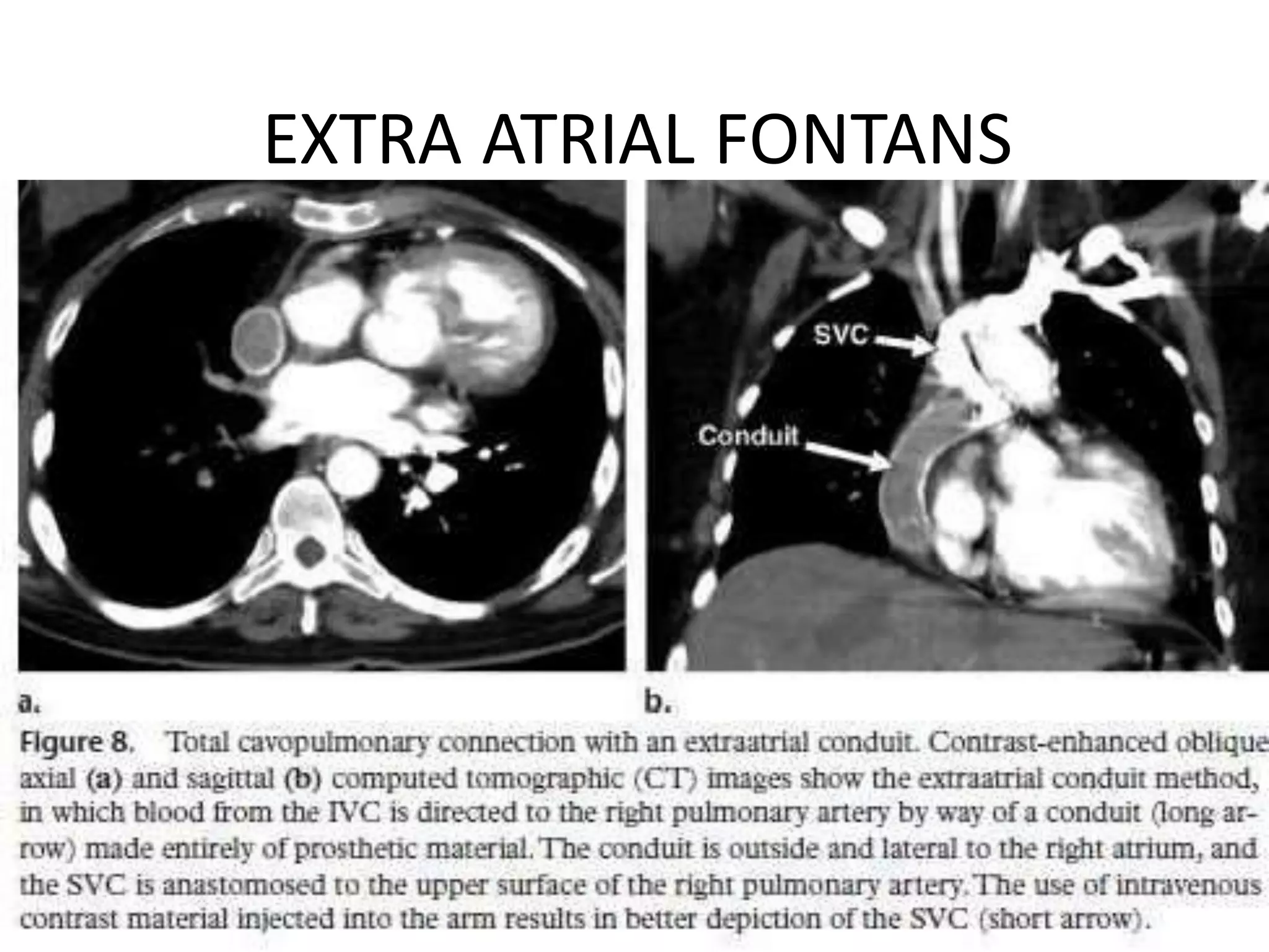 Fontan circulation | PPTX