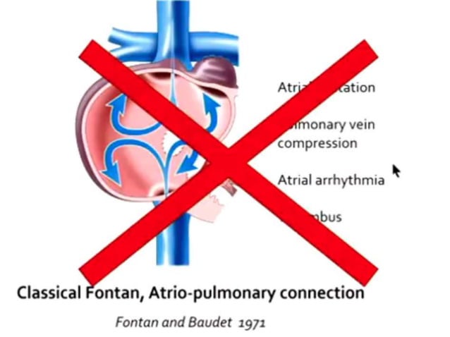 Fontan circulation | PPTX
