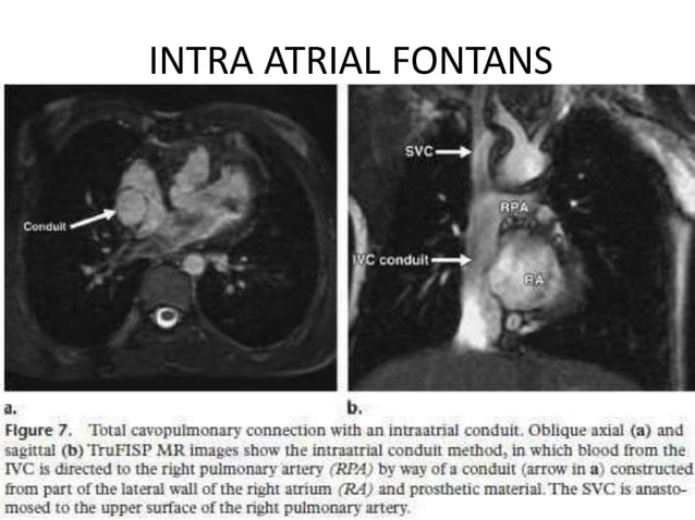 Fontan circulation | PPTX